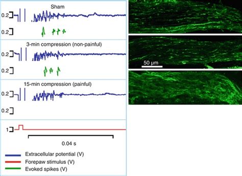 Intervertebral Disc Herniation Pathophysiology And Emerging Therapies