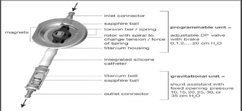 The Adjustable Progav Shunt A Prospective Safety And Reliab Neurosurgery The Adjustable Progav Shunt A Prospective Safety And Reliab Neurosurgery