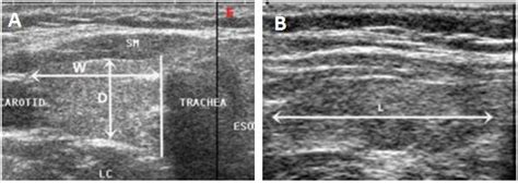 Thyroid Lobe Measurement A Transverse Ultrasound Grayscale Showing Download Scientific