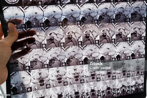 Ct 검사 및 그것에 두개골의 근접 촬영 건강의 두뇌 다른 예측을 보여주는 머리의 Mri 의료 이미지 자기 공명 영화 X 선 환자를 검사 과학에 대한 스톡 사진 및 기타