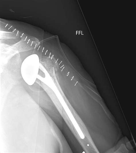 Shoulder And Elbow Surgery Proximal Humerus Fracture Dislocation With Malunion Of The Humeral