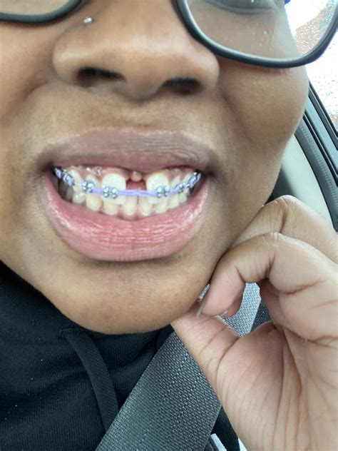 My Braces Journey Begins R Braces
