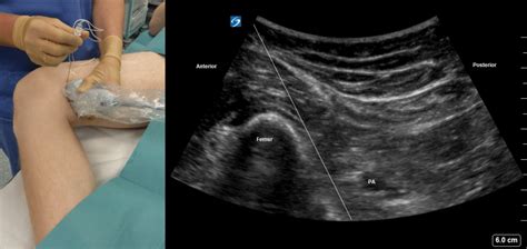 Motor Sparing Blocks For The Knee Wfsa Resources
