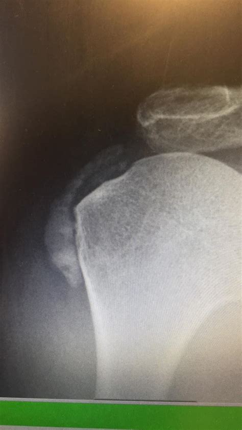Now Thats What I Call Calcification Shoulder Elbow Hand