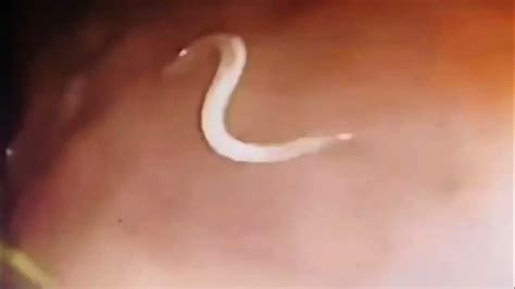 Pinworm In Colon During Endoscopy Youtube