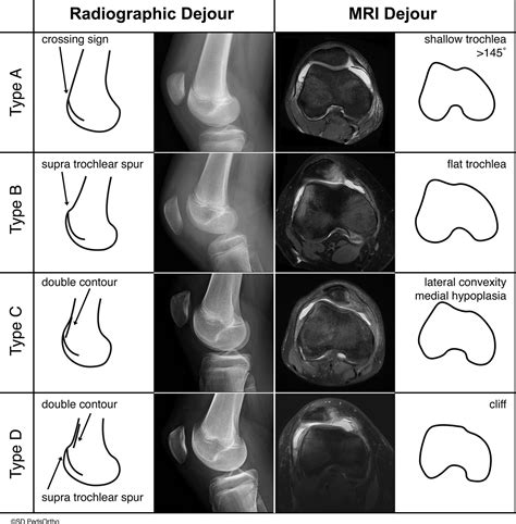 Trochlea Femur Mri