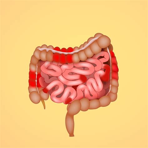 Ibs Vs Crohns Disease Overlaps And Differences Juvia