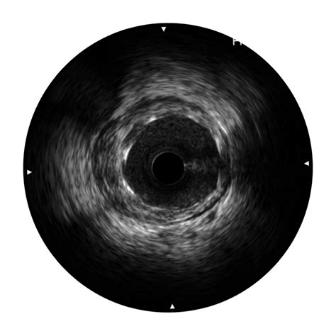 V Reader® V10 心血管介入 深圳开立生物医疗科技股份有限公司