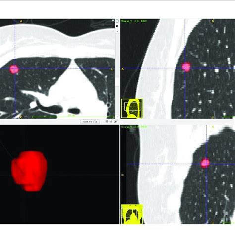 3d Segmentation Of Pulmonary Nodules By Itk Snap Software Download