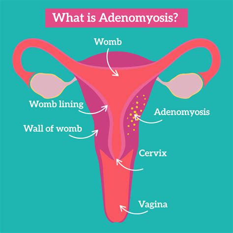 What Is Adenomyosis Hottea Mama