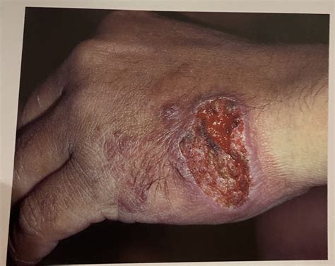 Present And Future Infectious Tropical Travel Rashes And The Impact Of