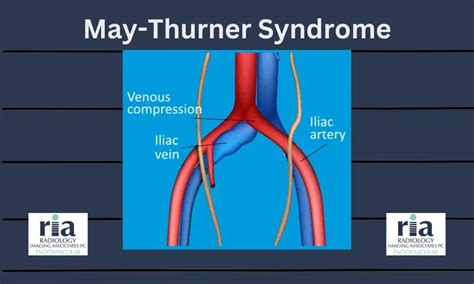 Understanding May Thurner Syndrome Interventional Radiology Located