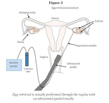 Ivf Egg Retrieval Thamarai Fertility