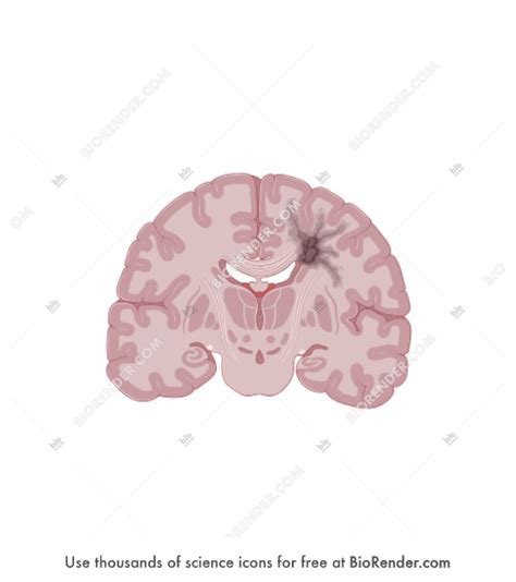 Free Brain Coronal Cut Demyelination Icons Symbols And Images Biorender