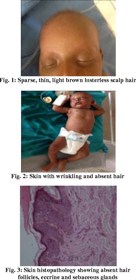 Figure 3 From A Rare Case Report Of Anhidrotic Ectodermal Dysplasia In A Newborn Semantic Scholar