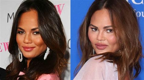 Chrissy Teigen Plastic Surgery What Happened To Chrissy Teigens Face