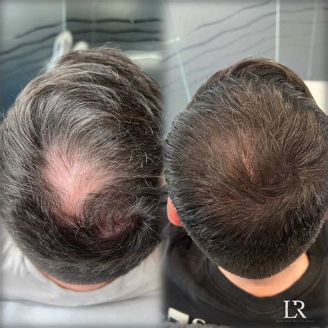Scalp Micropigmentation Free Consultation The Fab Clinic
