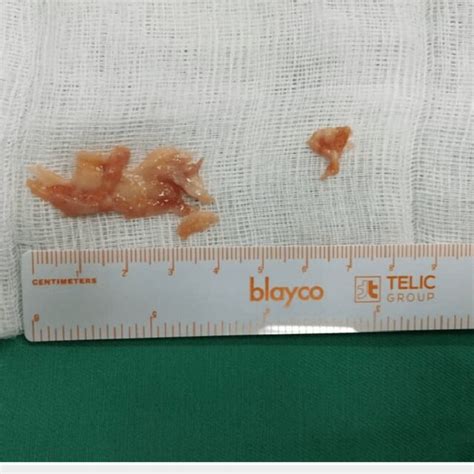 Figure Showing The Excised Granulomatous Tissue Abundant Granulomatous Download Scientific