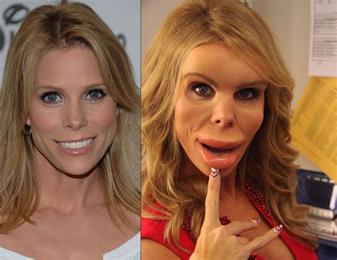 Botox Before And After Lips Gone Wrong