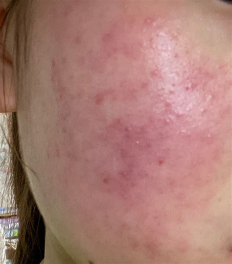 홍조 레이저 시너지가 효과가 없는것 같아요 지식in