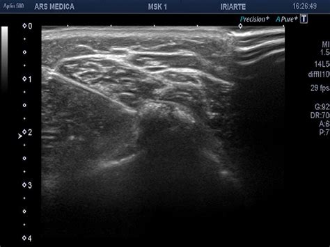 La Tendinitis Calcificante Es Una Patología Muy Frecuente Que Puede