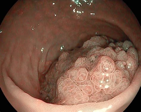 Cecal Sessile Polyp Lst G Gastrocloud