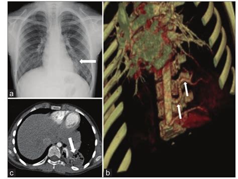 Intralobar Pulmonary Sequestration In A 9 Year Old Girl A