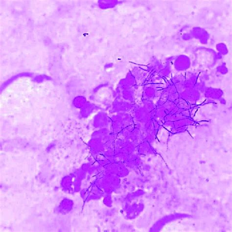 Sputum Gram Stain ×1000 Long Branched Gram Positive Filamentous Rods