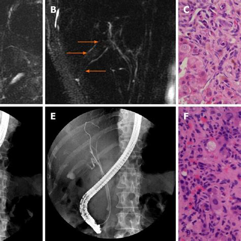Magnetic Resonance Cholangiopancreatography Images A And B And Download Scientific Diagram