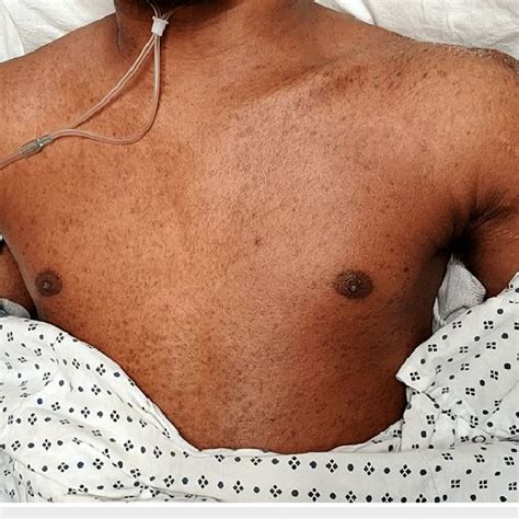 Maculopapular Rash Present Two Days After The Administration Of Download Scientific Diagram