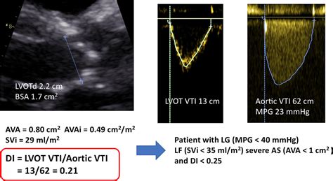 Dimensionless Index In Patients With Low Gradient Severe Aortic