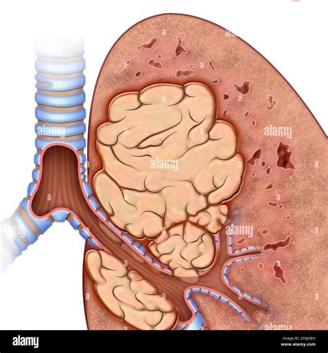 Schematic Illustration Of A Part Of The Lung Affected By Lung Cancer In