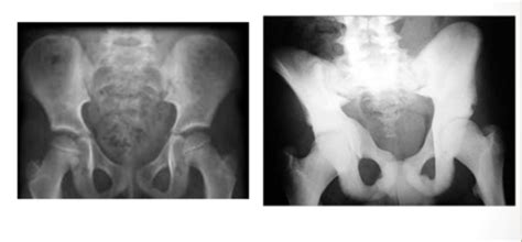 Bone Disorders Flashcards Quizlet