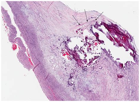 Histopathologic Validation Of Grayscale Carotid Plaque Characteristics Related To Plaque