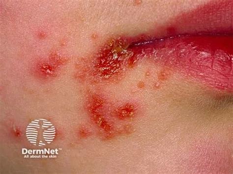 Angular Cheilitis Image