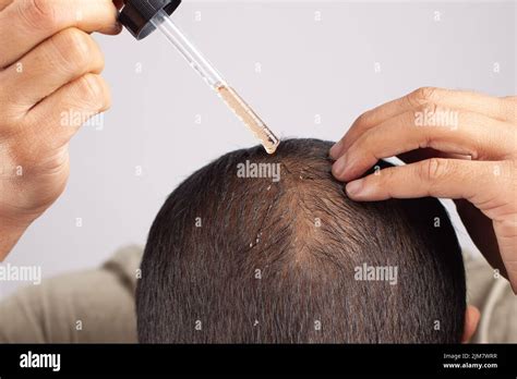 Minoxidil Oil Caucasian Male Using Hair Growth Oil By A Dropper On Scalp Promote Hair Growth