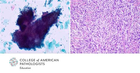 College Of American Pathologists Cap On Linkedin Develop Your Skills In Gynecologic Pathology
