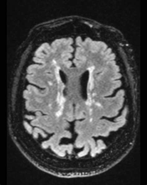 Multiple Sclerosis Mri Flair