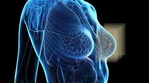 Call For Nhs To Give Women With Dense Breasts Extra Cancer Scans Bbc News