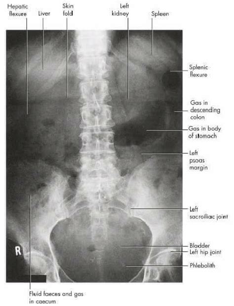 Unique How To Interpret An Abdominal X Ray Non Chronological Report Tes