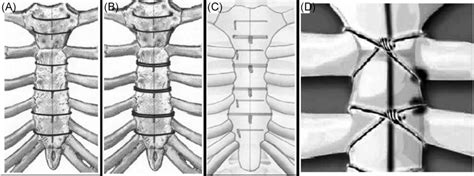 Sternal Closure Techniques A Single Wire Closure Described By Download Scientific Diagram