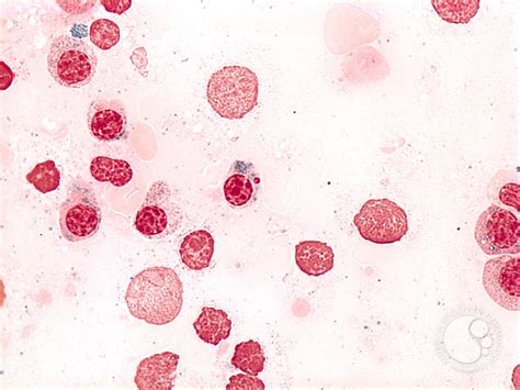 Refractory Anemia With Ring Sideroblasts 6
