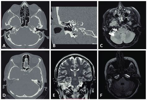 Extended Right Endolymphatic Tumour A Axial Bone Ct Scan With