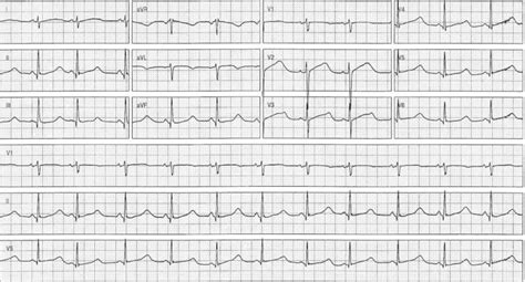 ECG Case 076 LITFL ECG Top 100 Self Assessment Quiz