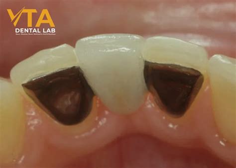 Maryland Bridge The Optimal Dental Bridge Solution For Preserving Natural Teeth Vta Dental Lab