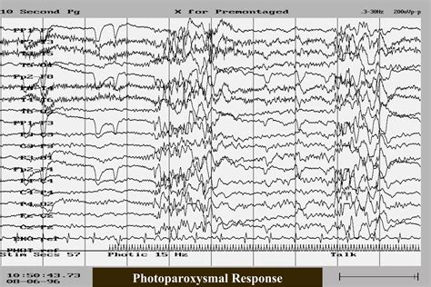 Normal Eeg Patterns Frequencies As Well As Patterns That May Simulate Disease Ppt
