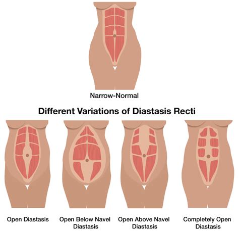 The Truths Of Diastasis Recti Divarication Trainerizeme
