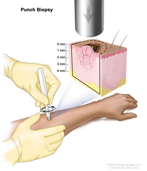 Melanoma Surgical Innovations