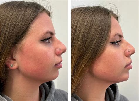 Chin Fillers For Round Face Safety Cost And Process