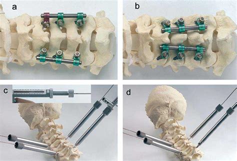 Instrumentación dorsal de la columna cervical con el nuevo sistema ...
